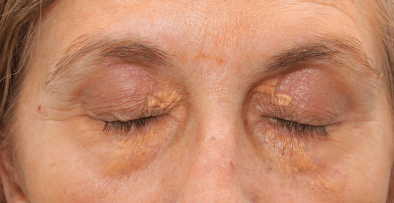 Los Xantelasmas: Todo lo que debemos saber - Terrassa 1877